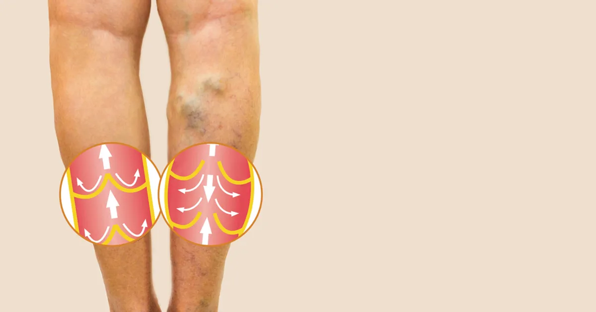 Deep Vein Thrombosis Symptoms: Do You Have DVT? - ActiveBeat - Your ...