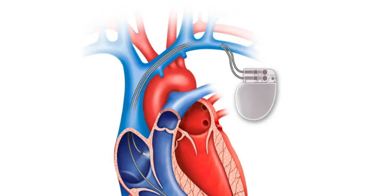 A Complete Guide to Living With a Pacemaker - ActiveBeat - Your Daily ...