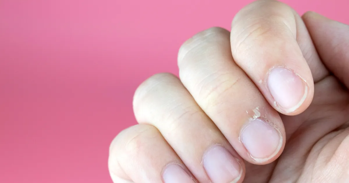 Effective Home Remedies for Hangnails - Page 2 of 12 - ActiveBeat ...